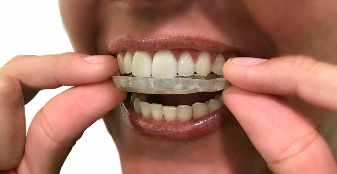 ¿Cómo sé si mi férula de descarga es adecuada? - Instituto Maxilofacial