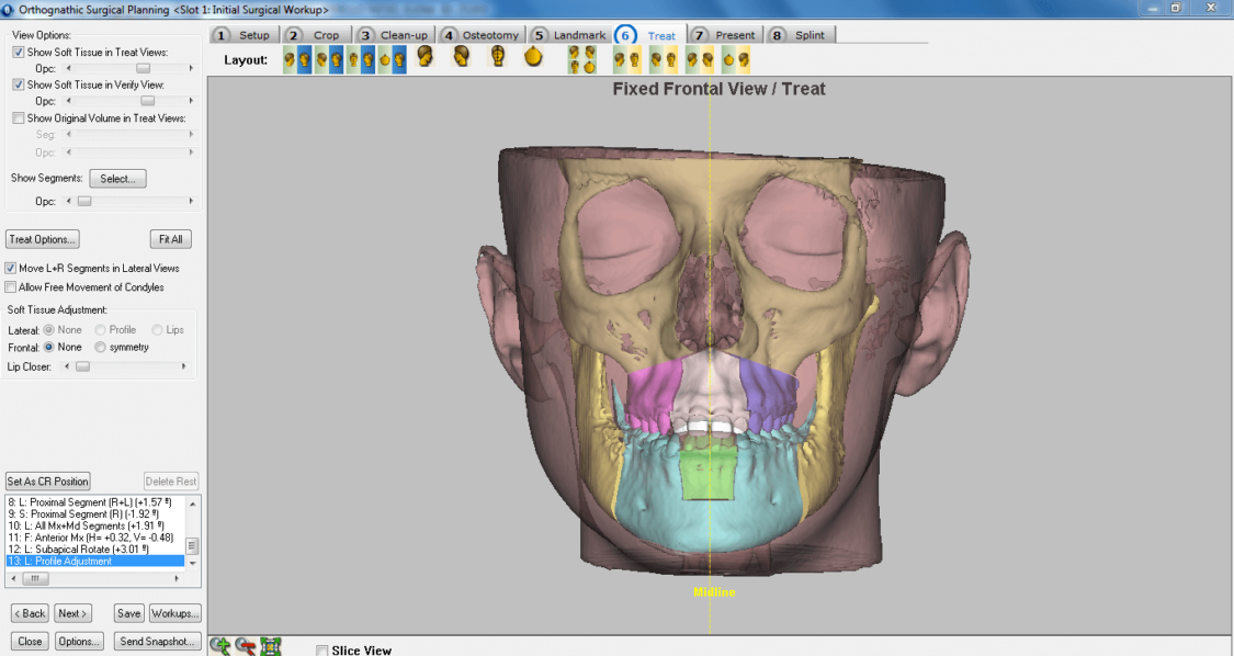 3D Planning in Orthognatic Surgery - Instituto Maxilofacial