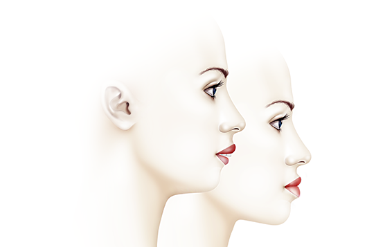 Mandibular Retrognathia or Class 2 - Orthognathic Surgery