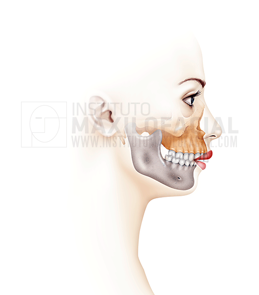 Retrognatia Manbidular o Clase 2 » Cirugía Ortognática - Instituto ...