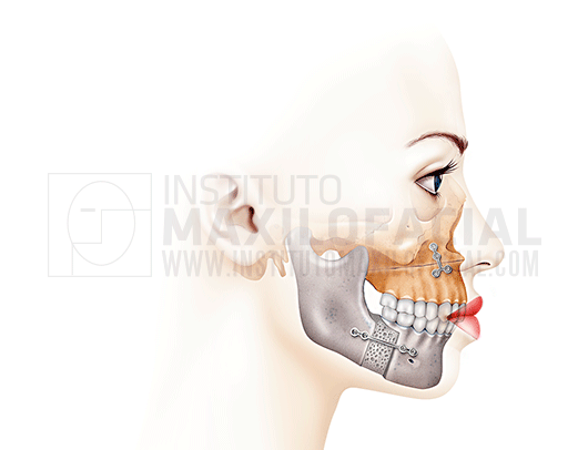 Retrognatia Manbidular o Clase 2 » Cirugía Ortognática - Instituto ...
