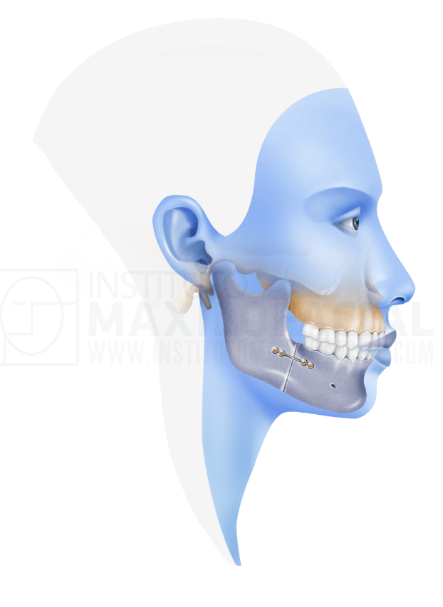 Mandibular Prognathism or Class 3 - Orthognathic Surgery