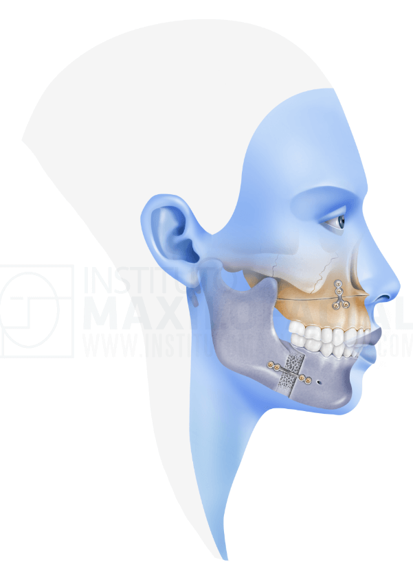 Clase II o Retrognatia Mandibular» Cirugía Ortognática - Instituto ...