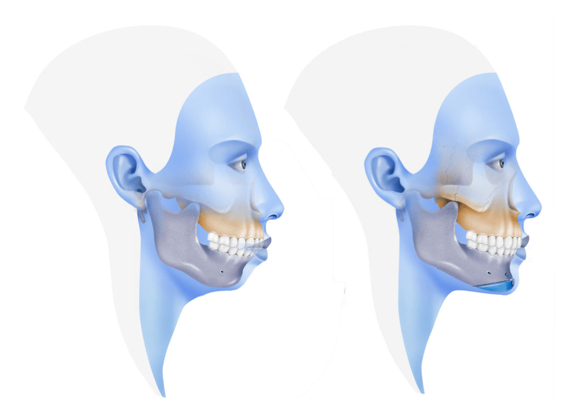 Mentoplasty - Facial Cosmetic Surgery - Instituto Maxilofacial