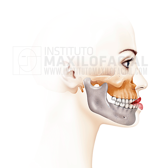 Mandibular Prognathism or Class 3 - Orthognathic Surgery