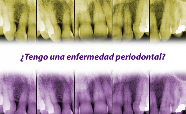 Síntomas de la enfermedad periodontal: Parte 1 - Instituto Maxilofacial