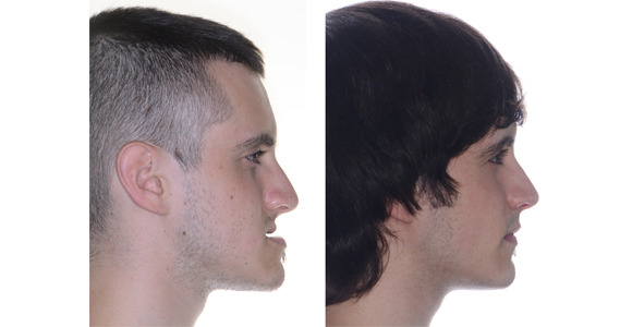 David - Cirugía ortognática bimaxilar - Instituto Maxilofacial