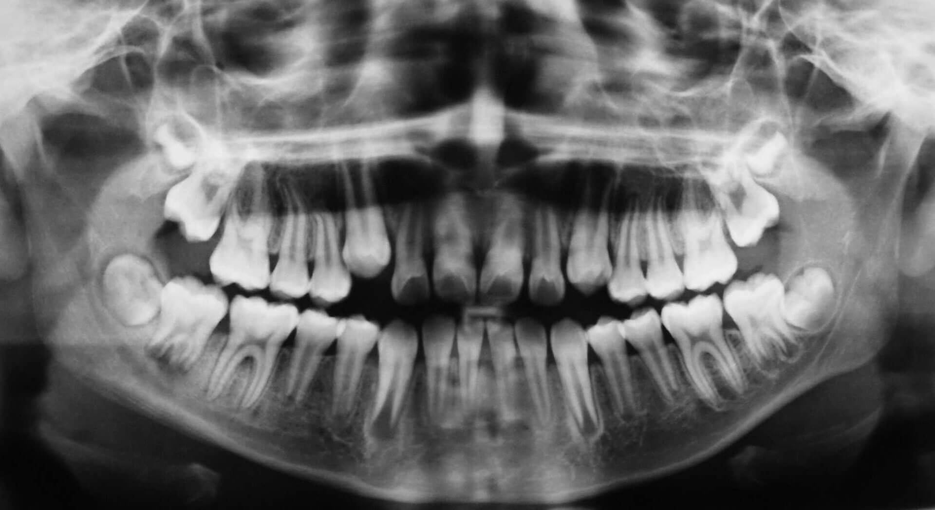 ¿Cómo se diagnostica una muela del juicio impactada? - Instituto ...