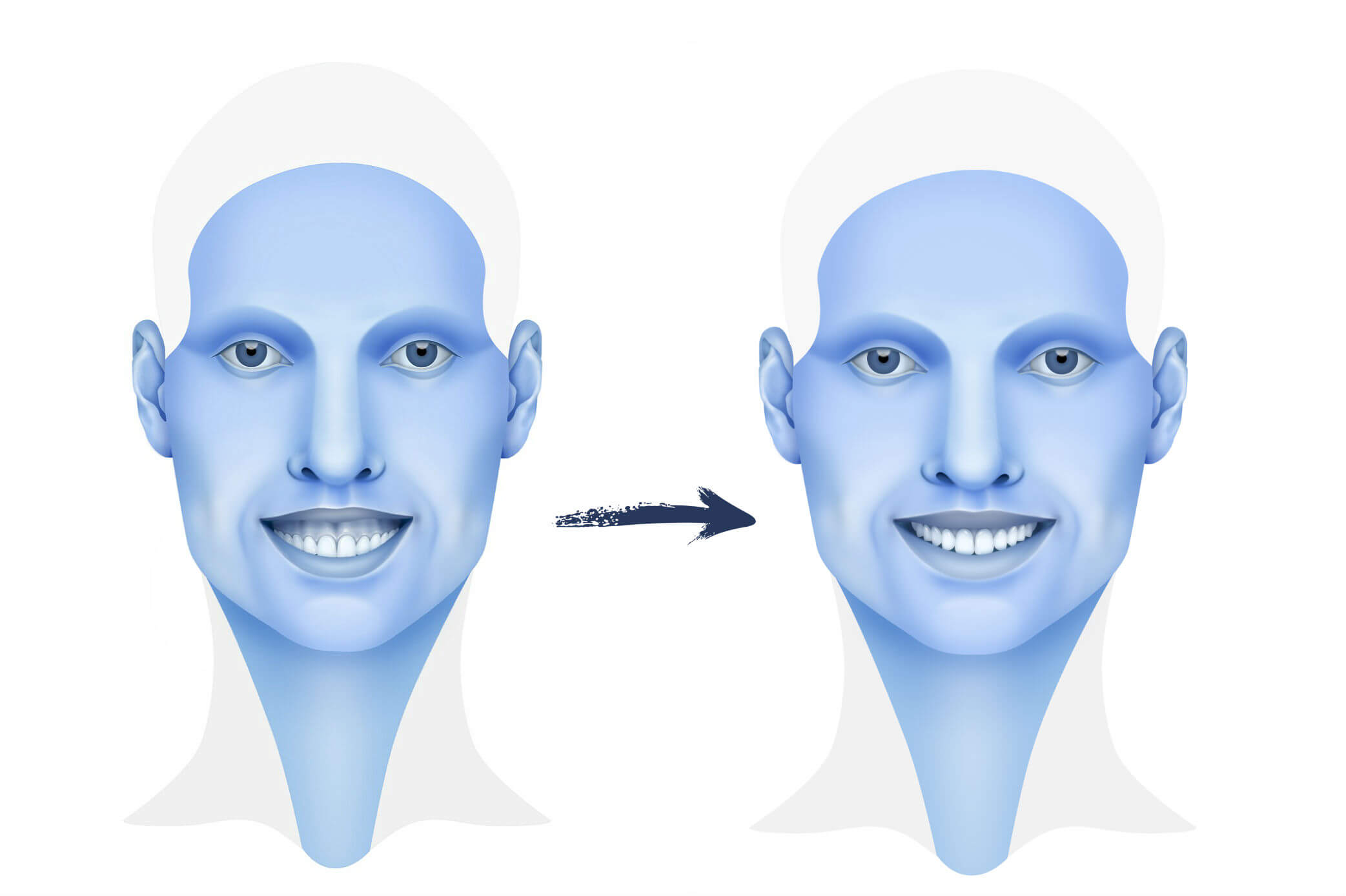 Síndrome de cara larga: que és y cómo se trata - Instituto Maxilofacial Síndrome de cara larga: que és y cómo se trata - Instituto Maxilofacial