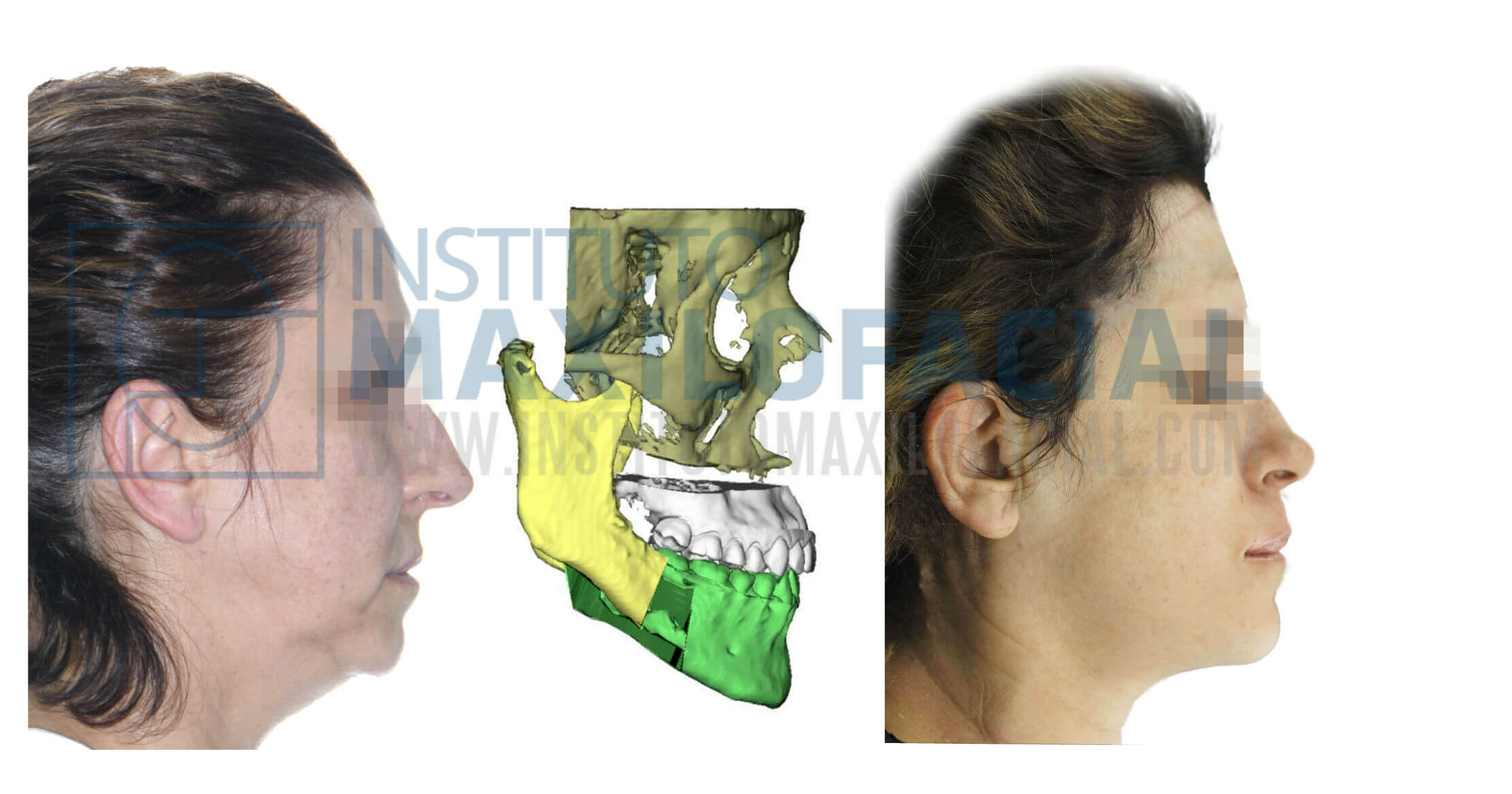 Reverse facelift: the most durable and natural facial rejuvenation method - Instituto Maxilofacial