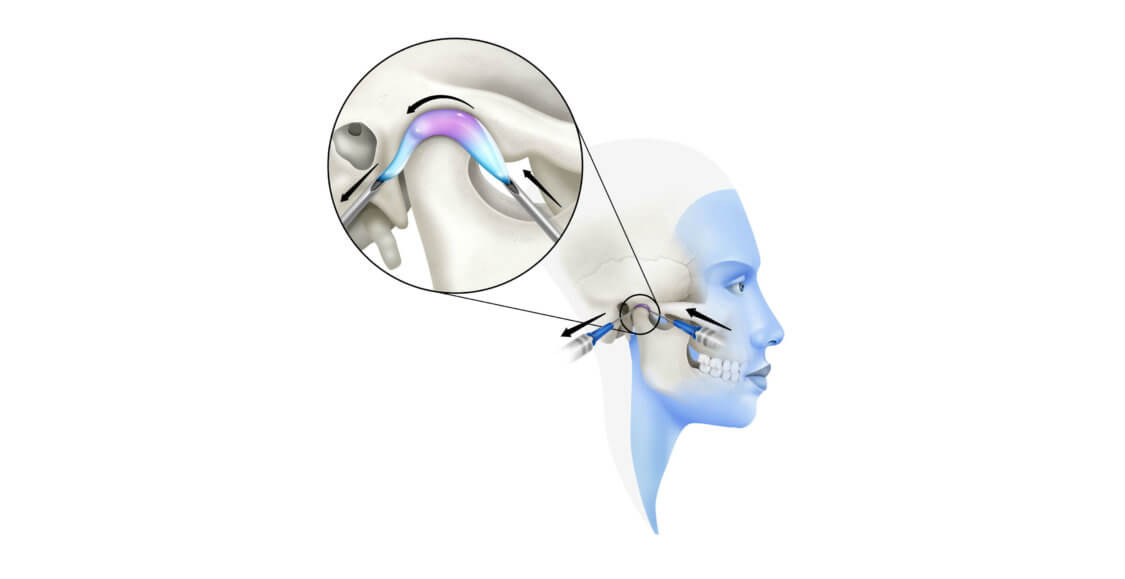 Artrocentesis de la articulación temporomandibular: qué es y para qué ...