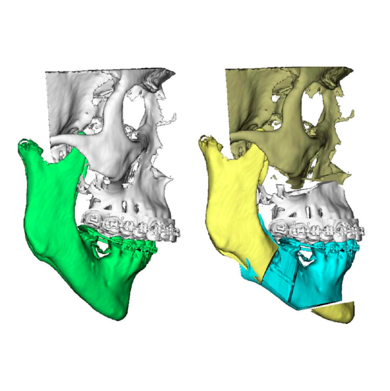 Planificación 3D en Cirugía Ortognática - Instituto Maxilofacial