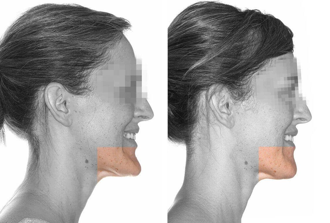 Mentoplastia Caso 1 - Instituto Maxilofacial