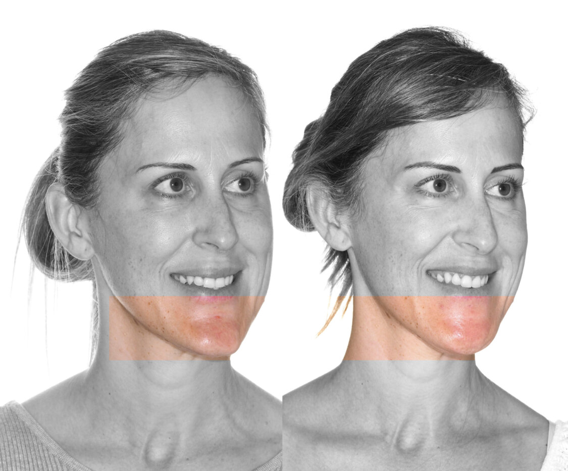 Mentoplastia Caso 1 - Instituto Maxilofacial