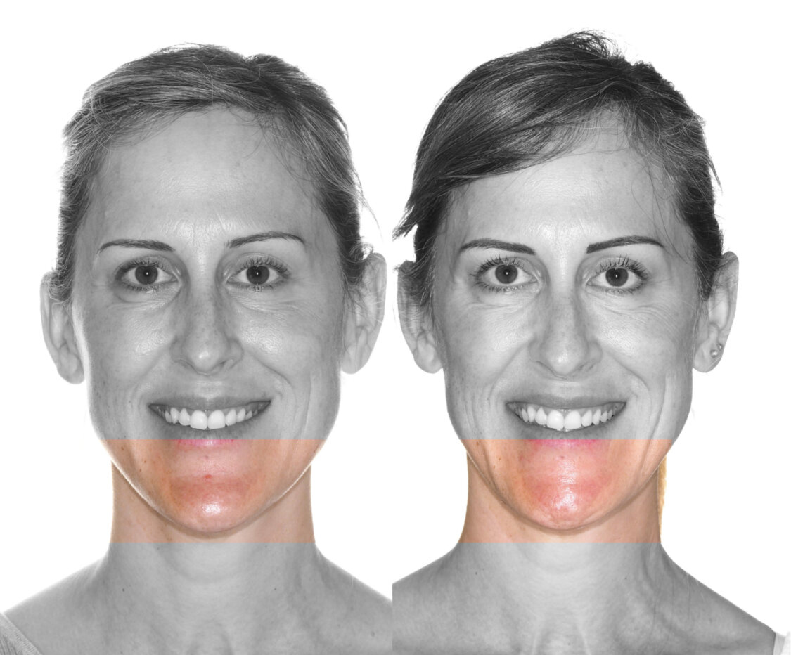 Mentoplastia Caso 1 - Instituto Maxilofacial