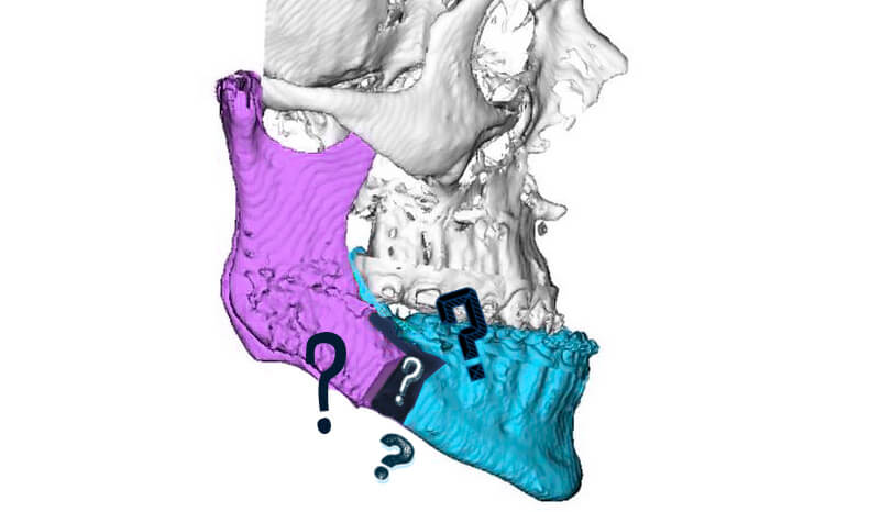 What are surgical gaps filled with? - Instituto Maxilofacial