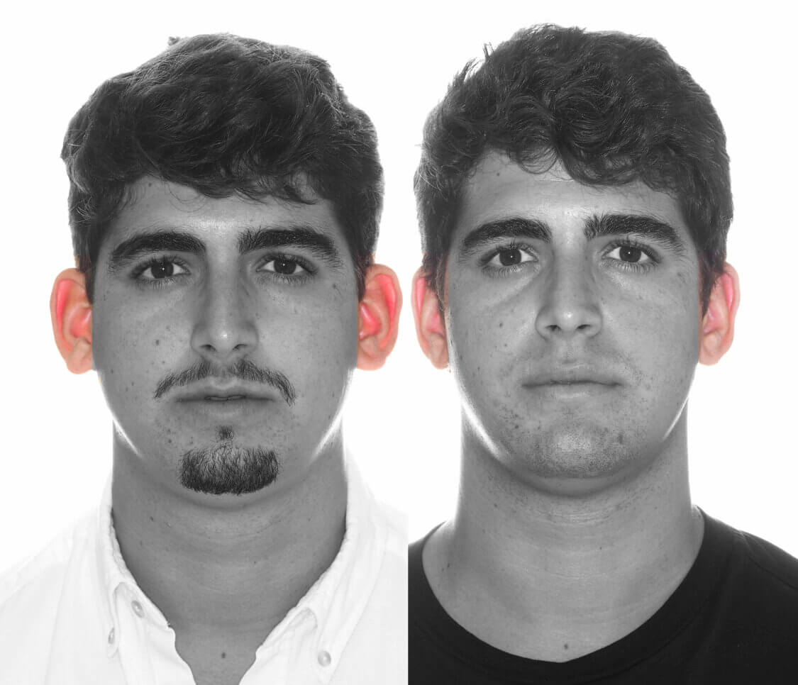 Otoplastia Caso 2 - Instituto Maxilofacial