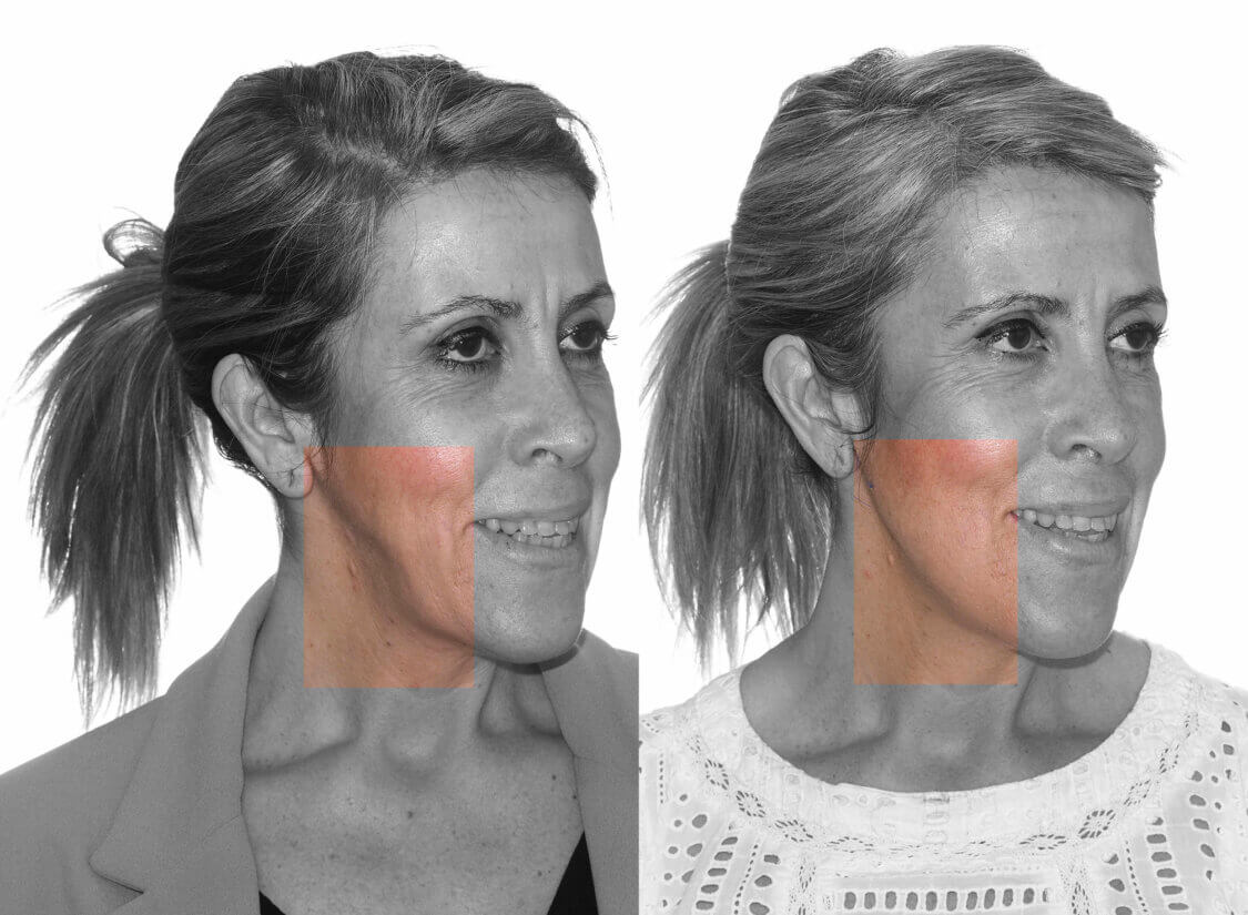 Prótesis faciales Caso 1 - Instituto Maxilofacial