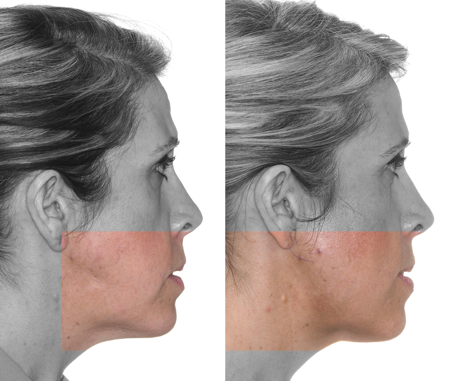 Prótesis faciales Caso 1 - Instituto Maxilofacial