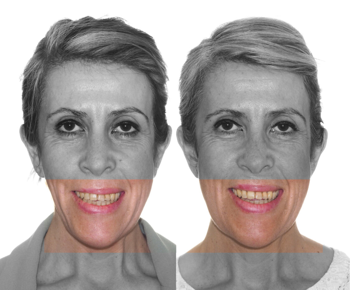 Prótesis faciales Caso 1 - Instituto Maxilofacial